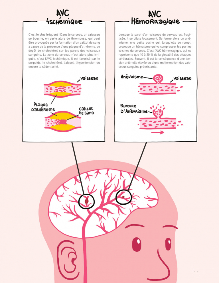L’accident vasculaire cérébral - Vocation Santé