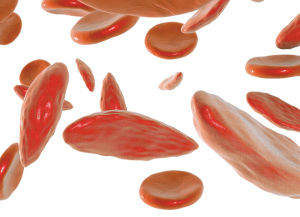 Thérapie génique : succès dans la drépanocytose - Vocation Santé